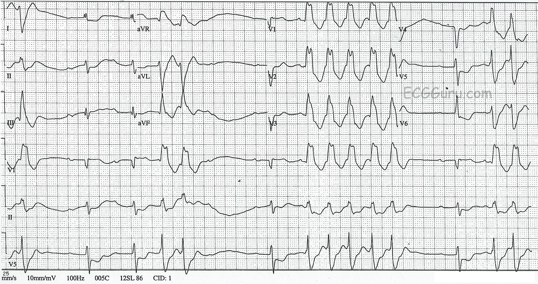 Non-Sustained Ventricular Tachycardia | ECG Guru - Instructor Resources Non-Sustained Ventricular Tachycardia | ECG Guru - Instructor Resources